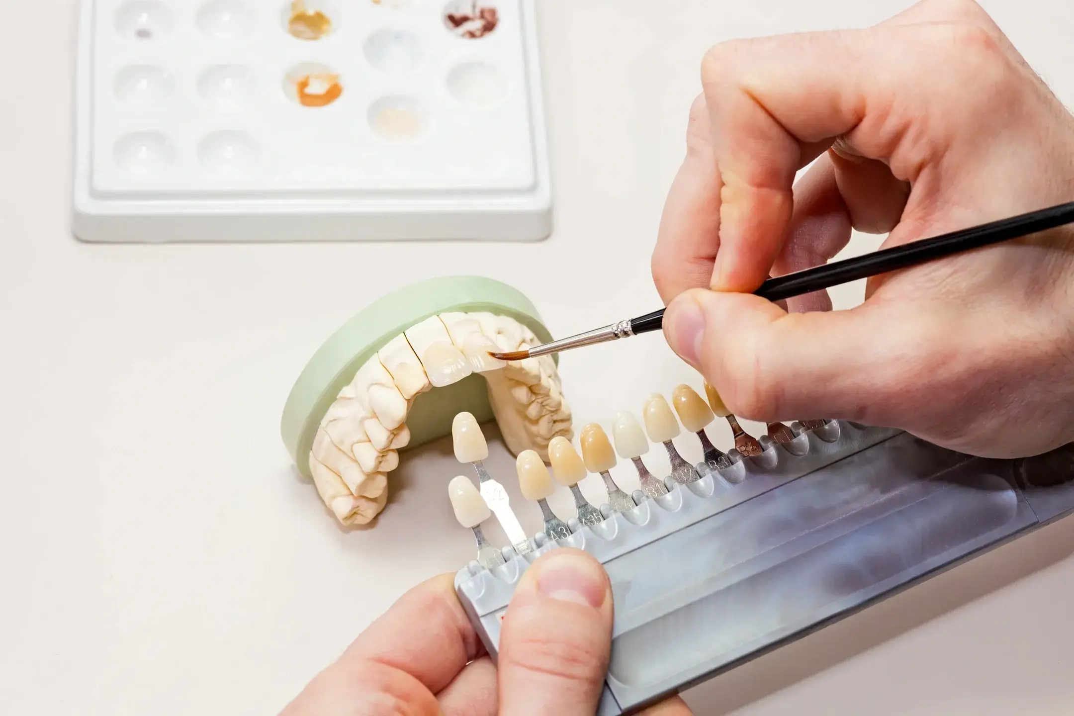 Bridges - Holmes Dental Lab
